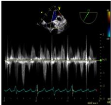 Journal of Cardiology & Cardiovascular Therapy (JOCCT) | Juniper Publishers