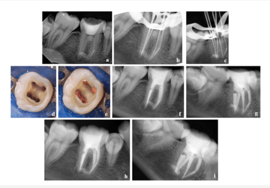 Advances in Dentistry and Oral Health (ADOH) | Juniper Publishers