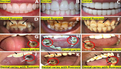 Advances in Dentistry and Oral Health (ADOH)